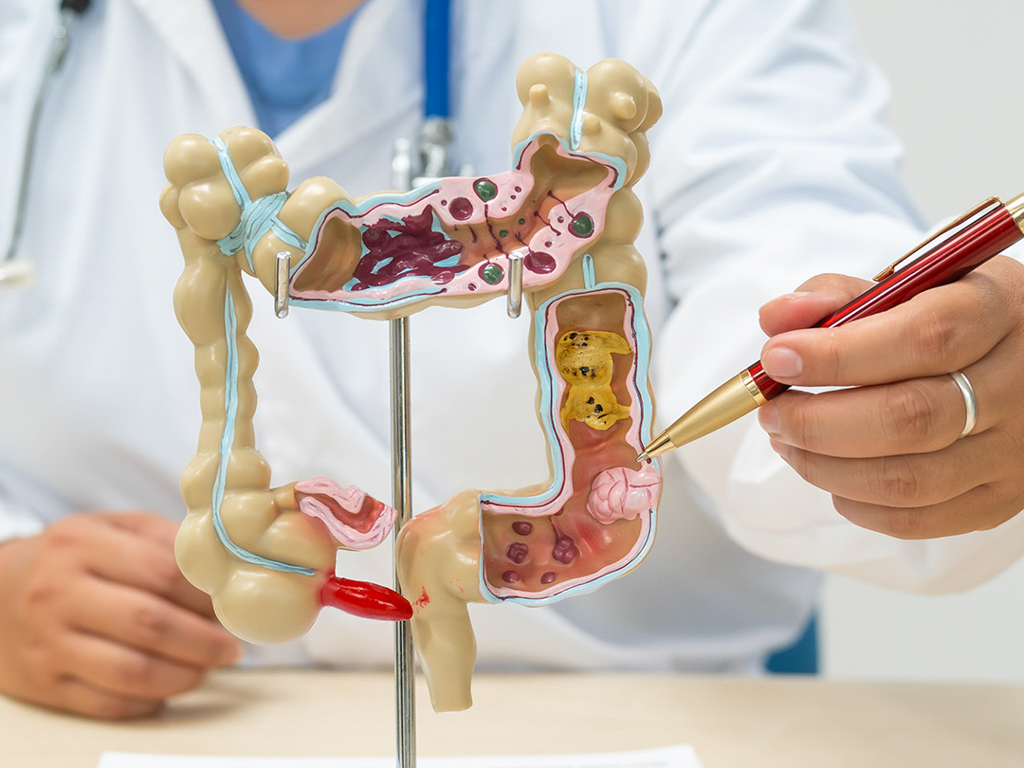 Guidelines for Colorectal Cancer Screening | Select Health